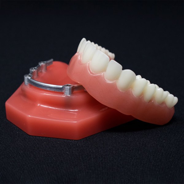 Six Implant Maxillary Bar with Overdenture - BoneModels™
