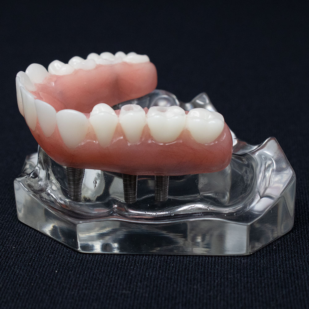 Direct Screw Retained Model - BoneModels™