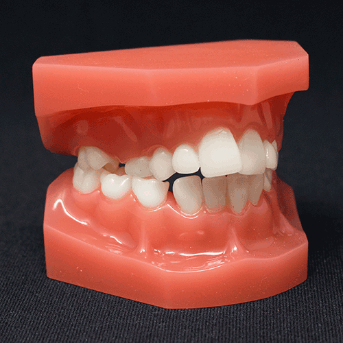 Orthodontic Typodont | Class 2 – Division 1 Open Bite Narrow Arches ...