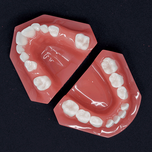 Orthodontic Typodont | Class 2 – Division 1 Open Bite Narrow Arches ...