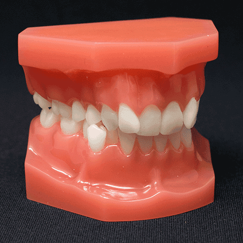 Orthodontic Typodont | Class 2 – Division 2 Permanent Dentition ...