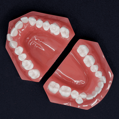 Orthodontic Typodont | Class 2 – Division 2 Permanent Dentition ...