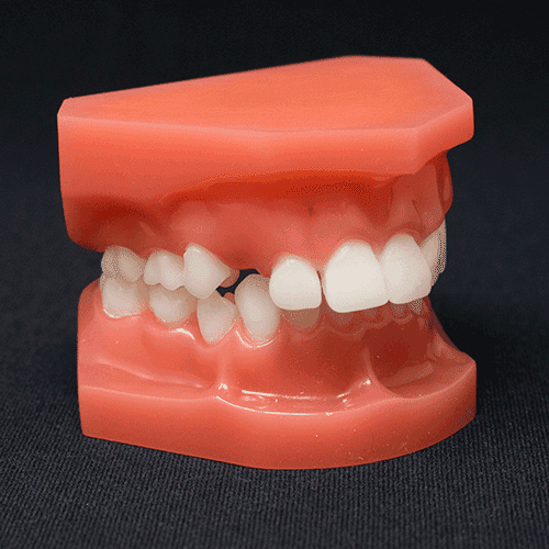 Orthodontic Typodont | Class 2 – Division 1 Excessive Overjet/Overbite ...