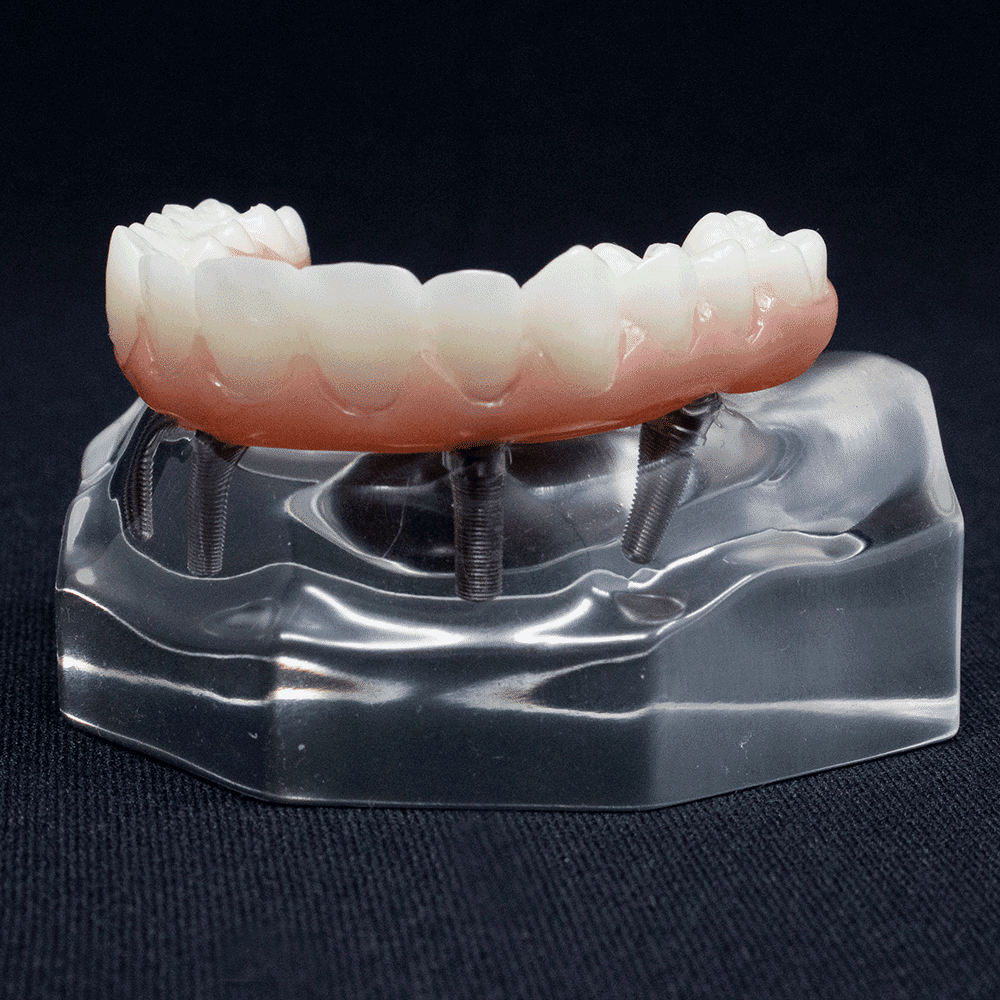 Complete Restoration on Four Implants Model - BoneModels™