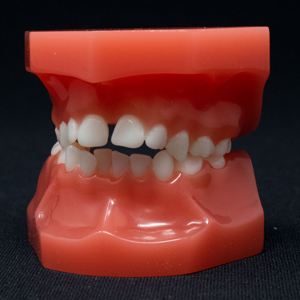 Pedodontic Open Bite - BoneModels™